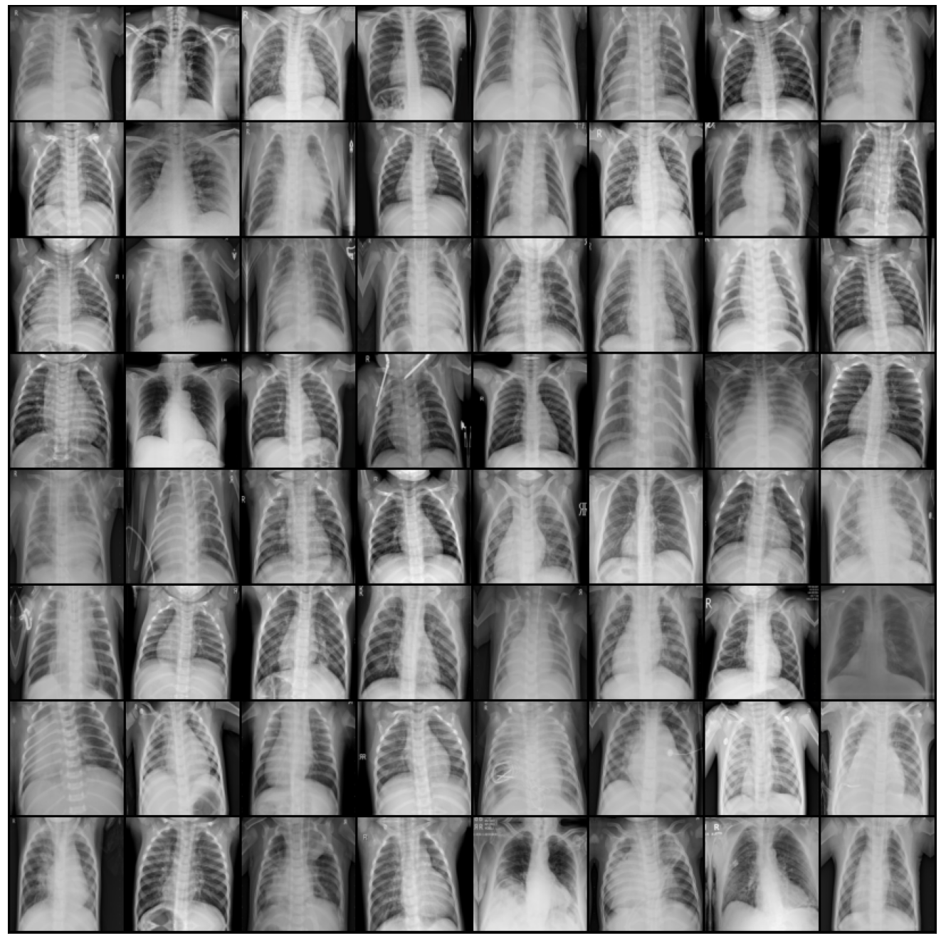Chest X-Ray Pneumonia Classification Using ResNet. | Yu Cao